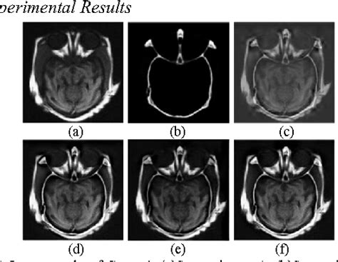 Figure 1 From Multimodal Medical Image Fusion Based On Nonsubsampled