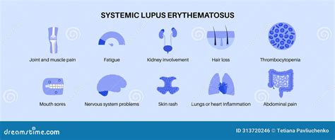 Systemic Lupus Erythematosus Vector Illustration 313720246