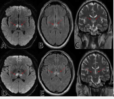 Bilateral Thalamic Infarcts Suggestive Of Stroke From Occlusion Of Aop