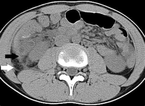 Transverse Ct Image Of 13 Year Old Boy With Complicated Appendicitis