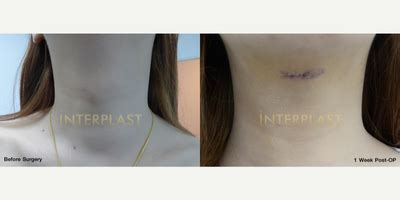 Adams Apple Reduction Before And After Pictures Realself