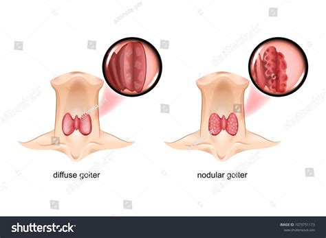 Vector Illustration Diffuse Nodular Goiter Thyroid Stock Vector Royalty Free 1073751173 Vector Illustration Diffuse Nodular Goiter Thyroid Stock Vector Royalty Free 1073751173