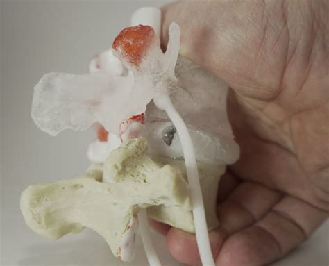 Far Lateral Lumbar Disc Herniation And The Importance Of Localization