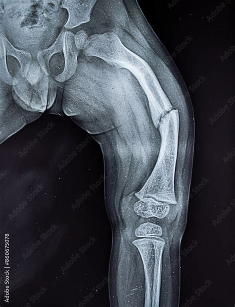 X Ray Of Thigh Showing Femur Fracture And Metaphyseal Flaring Bowed