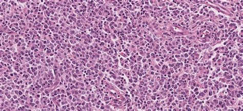 Diffuse Follicular Lymphoma Variant An Unusual Case With Predominantly A Large B Cell Lymphoma