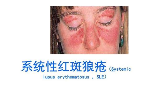 为什么系统性红斑狼疮被称为不死的癌症医生告诉你 癌症肿瘤频道 东方养生