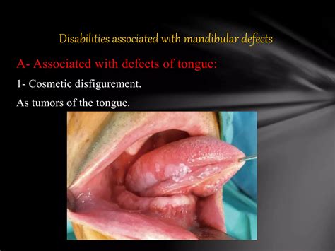 Mandibular Defects Maxillofacial Prosthesis Pptx Dental Health Mandibular Defects Maxillofacial Prosthesis Pptx Dental Health