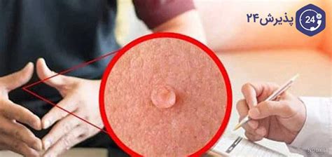 عکس تبخال تناسلی مردان عکس نودی