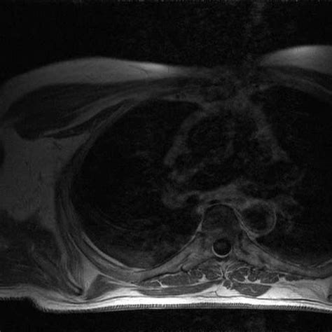 Pdf Bias Field Correction For Mri Images