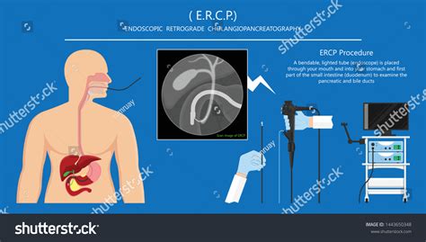 Endoscopic Retrograde Cholangiopancreatography Ercp Diagnose Treat Stock Vector Royalty Free
