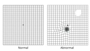Amsler Grid Test Chart For Macular Disease Eye Health Nepal