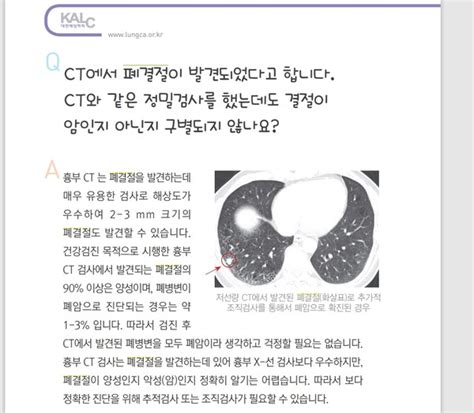 폐결절 폐암의 씨앗일 수 있다”