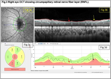 Spark Imagewise 67 Optic Disc Drusen With Retinal Nerve Fiber Layer Defects Suraj Eye Institute