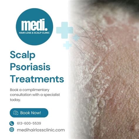 Scalp Psoriasis Treatment Ottawa And Toronto Scalp Treatments Medi