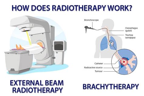 External Radiation Therapy
