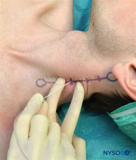 Ultrasoundguided Cervical Plexus Block Nysora Pain Control Using