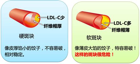 体检发现颈动脉斑块该吃药还是手术 知乎