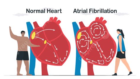 Data Comparison Vector Png Images Data Comparison Of Normal Heart And