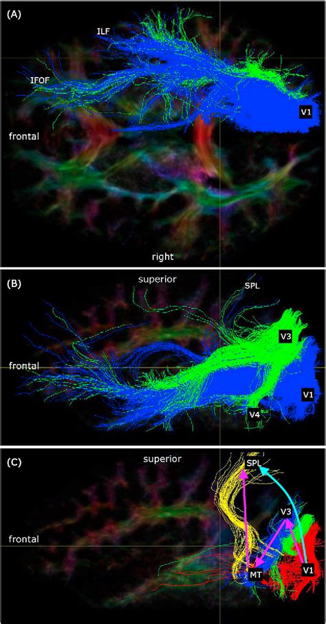 Figure 1 From Proposal For Human Visual Pathway In The Extrastriate Cortex By Fiber Tracking