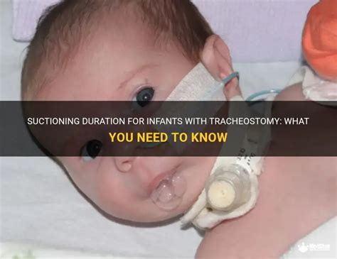 Suctioning Duration For Infants With Tracheostomy What You Need To