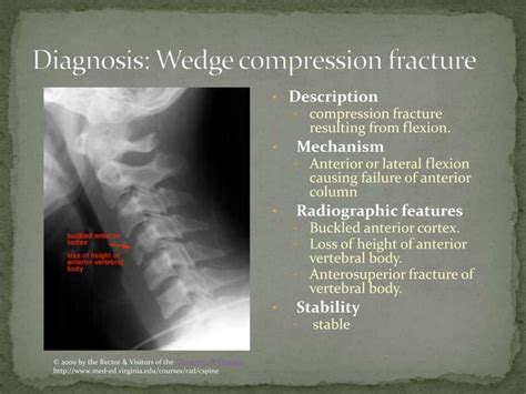 Wedge Compression Fracture Pptx
