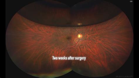 Vitrectomy For Total Rhegmatogenous Retinal Detachment Youtube