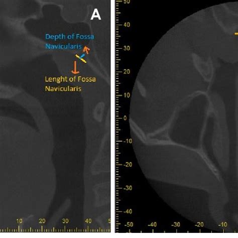 The Mean Values Of Fossa Navicularis Measurements According To Sex Download Scientific Diagram