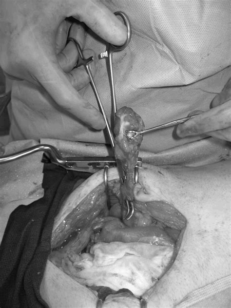 Photograph Taken During The Operation Revealing 2 Perforations Of A