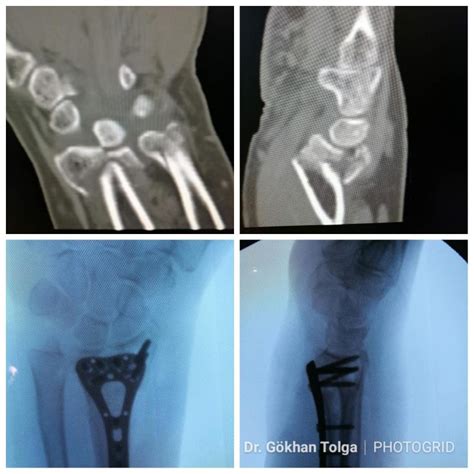 Gokhan Tolga Akbulut On Linkedin 60 Y Distal Radius Fx Done Open Reduction Internal