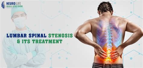 What Is Lumbar Spinal Stenosis Its Causes Symptoms And Treatment