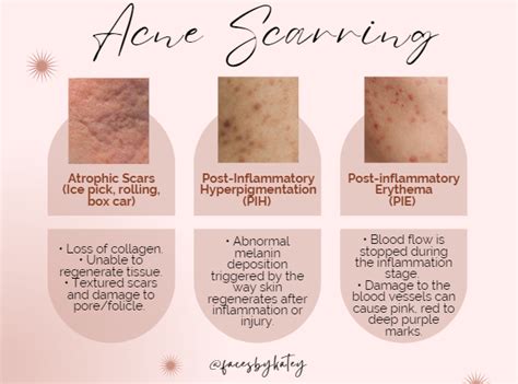 Atrophic Acne Scars