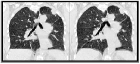 Figure 2 From Evaluation Of 4d Ct Acquisition Methods Designed To Reduce Artifacts Semantic