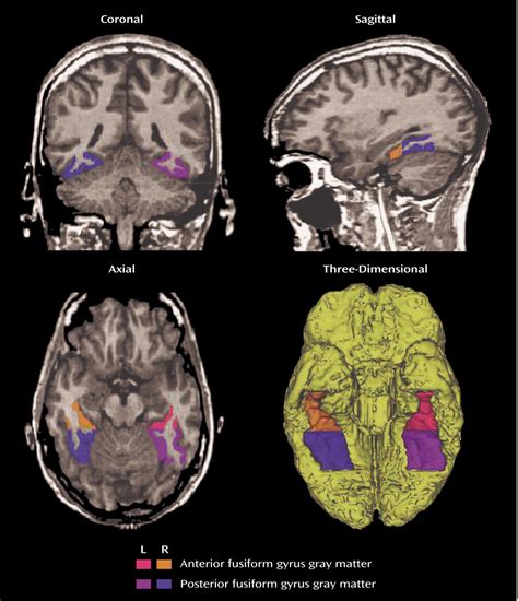 Association Between Reduced Extraversion And Right Posterior Fusiform