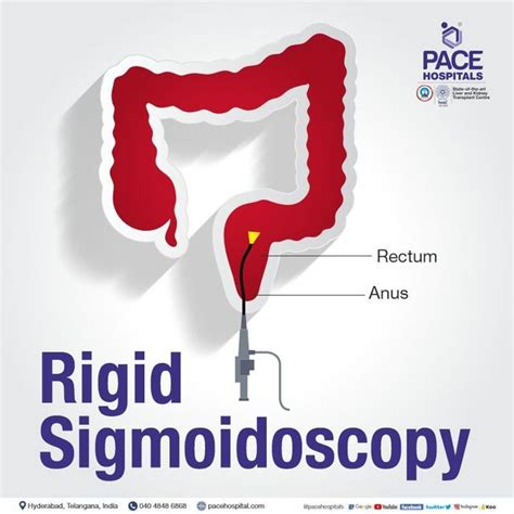 Sigmoidoscopy
