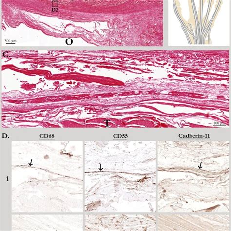Example Mr Image Of Extensor Tenosynovitis At Mcp 4 Arrow And Flexor Download Scientific