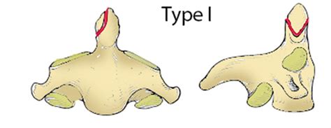 Odontoid Fracture Spine Orthobullets