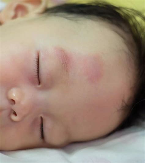 Mongolian Blue Spots In Newborn Causes Signs And Treatment