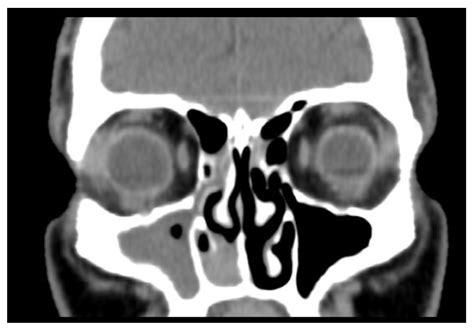 Olfactory Neuroblastoma