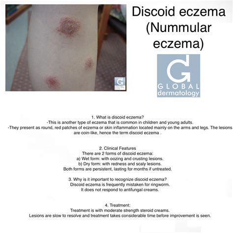 Summary Slides Discoid Eczema Nummular Eczema Christophe Hsu 徐華昌