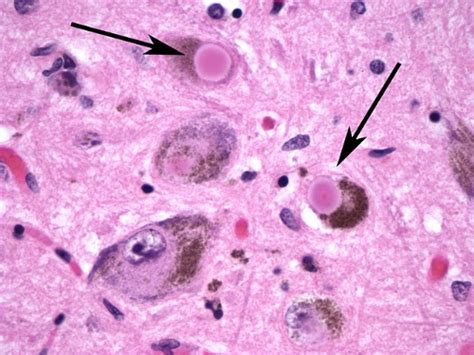 Lewy Bodies Alpha Synuclein Eosinophilic Inclusions Parkinsons Lewy Body Parkinsons