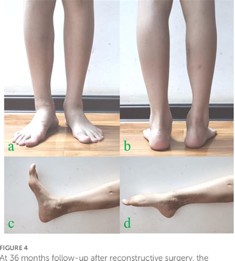 Figure 1 From Case Report Reconstruction Of Distal Medial Tibial