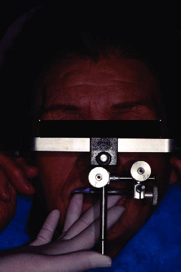 Taking The Facebow Transfer Download Scientific Diagram