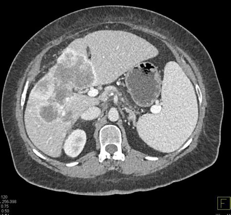 Cholangiocarcinoma Ct Cholangiocarcinoma Ct