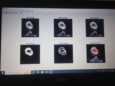 Nithyalakshmi S On Linkedin Matlab Medicalimaging