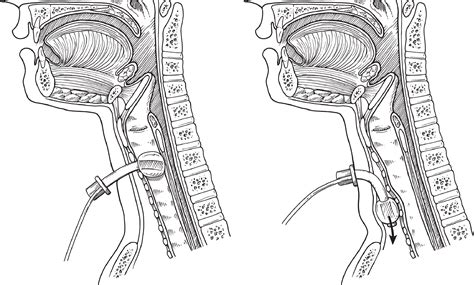 Recurrent Head And Neck Tumors In The Setting Of Previous