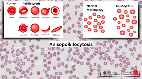 Anisopoikilocytosis Defination Types Morphology Causes And More