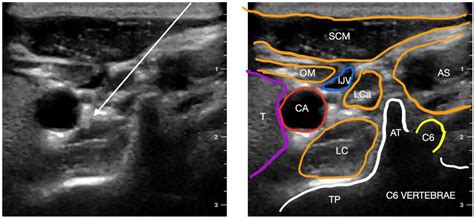 Cervical Stellate Ganglion Block My Xxx Hot Girl