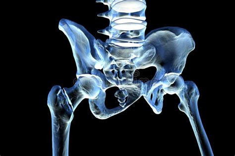 Basicervical Femur Fracture 3d Illustration Stock Illustration