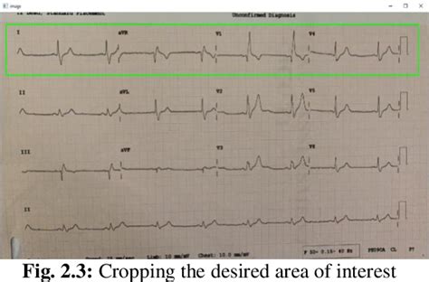 Figure From Digitalization Of ECG Records Semantic Scholar