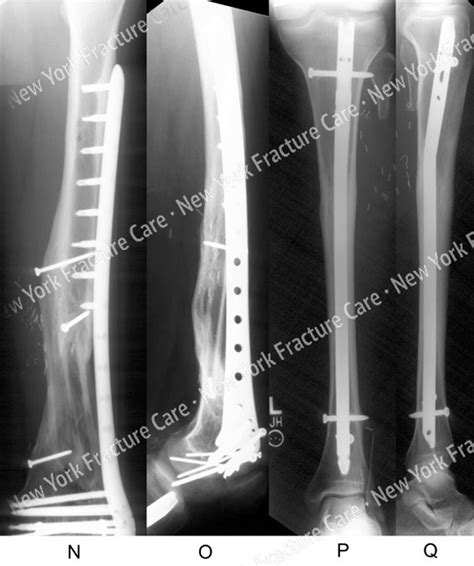 Complex Fractures New York Fracture Care